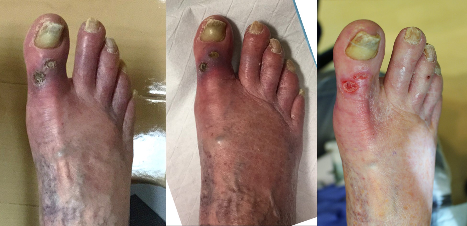 Reperfusion Syndrome And Critical Limb Ischemia Michael Cumming Md Mba