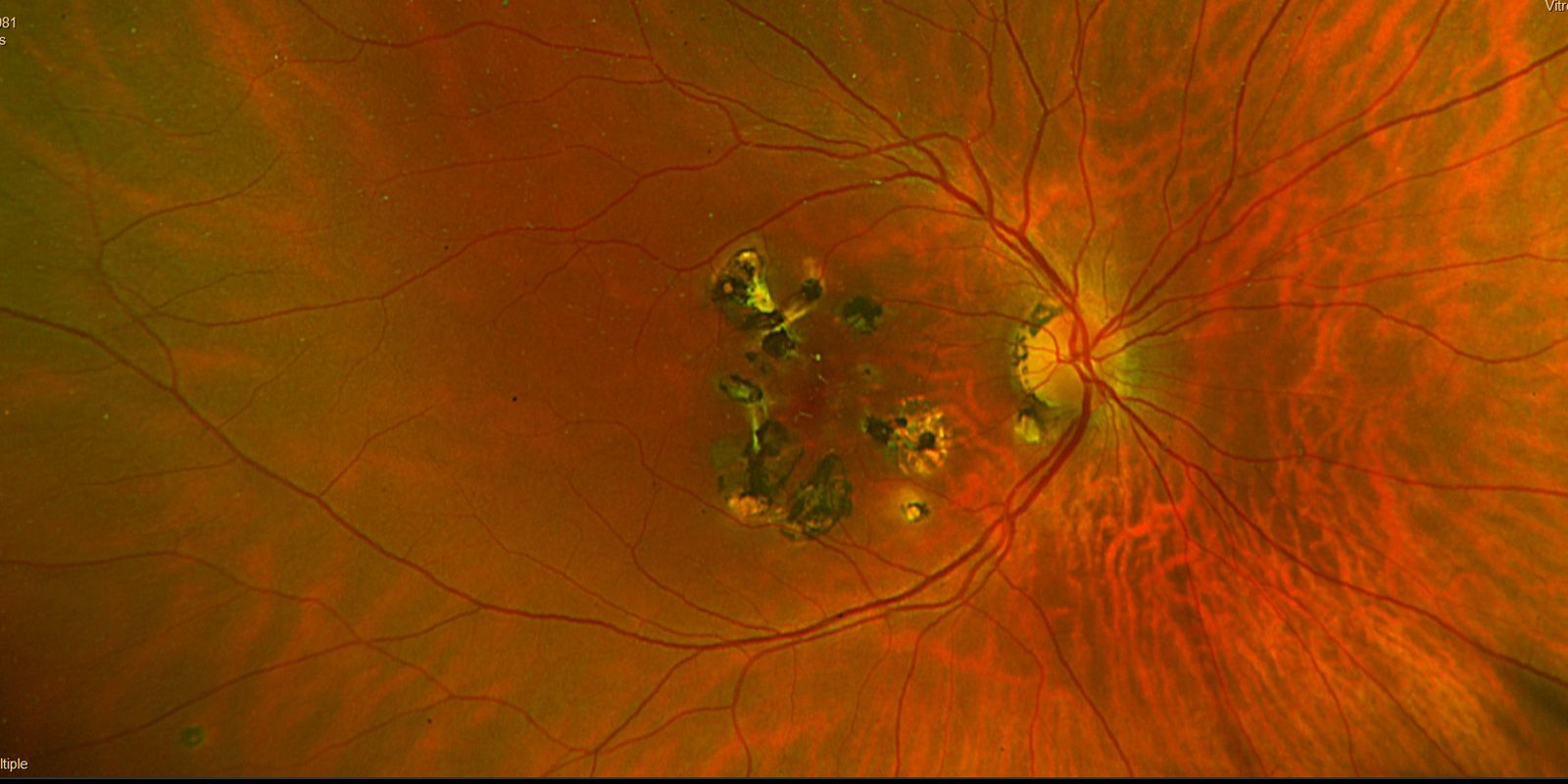 Vitreo Retinal Consultants, Inc.