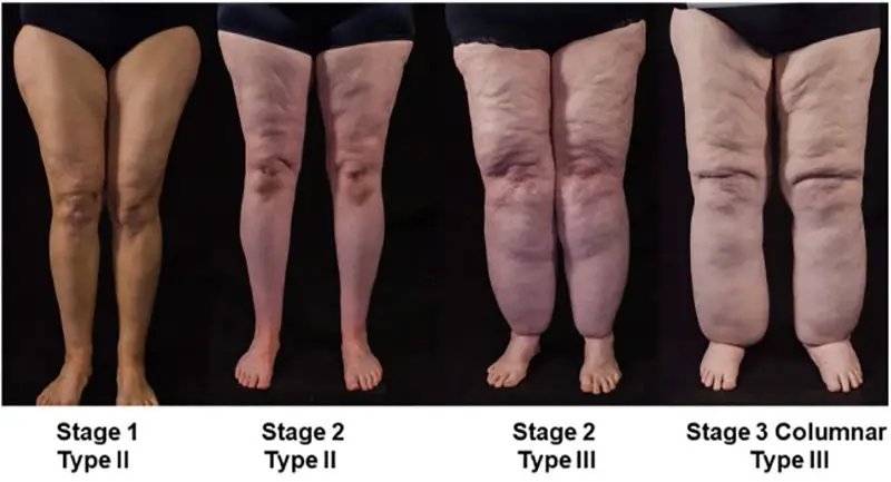 Lipedema Obesity Or Normal Fat Legs What Do Lipedema Legs Look Like