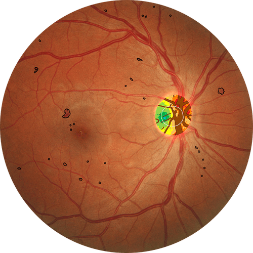 RetinaLyze - Efficient, safe and fast eye screenings