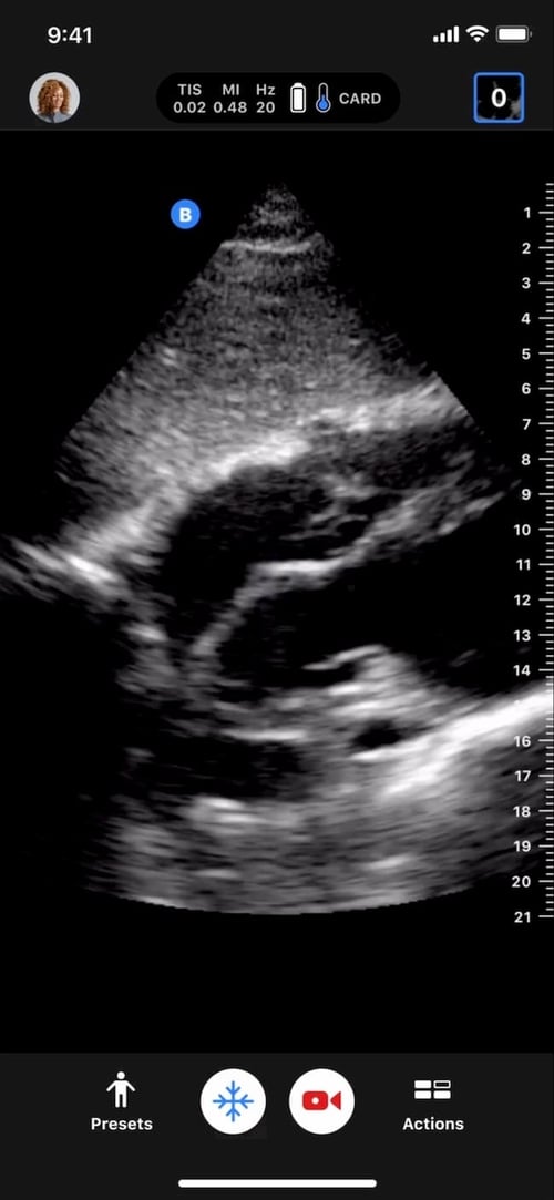 iQ+ Ultrasound | A single, whole-body imaging probe.