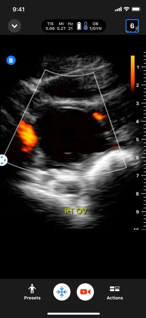 Portable ultrasound for OB/GYN and Labor & Delivery | Butterfly iQ3