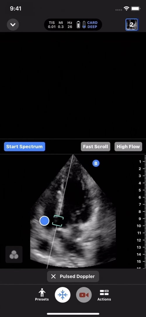 Point of care ultrasound at the bedside in Cardiology | Butterfly iQ3