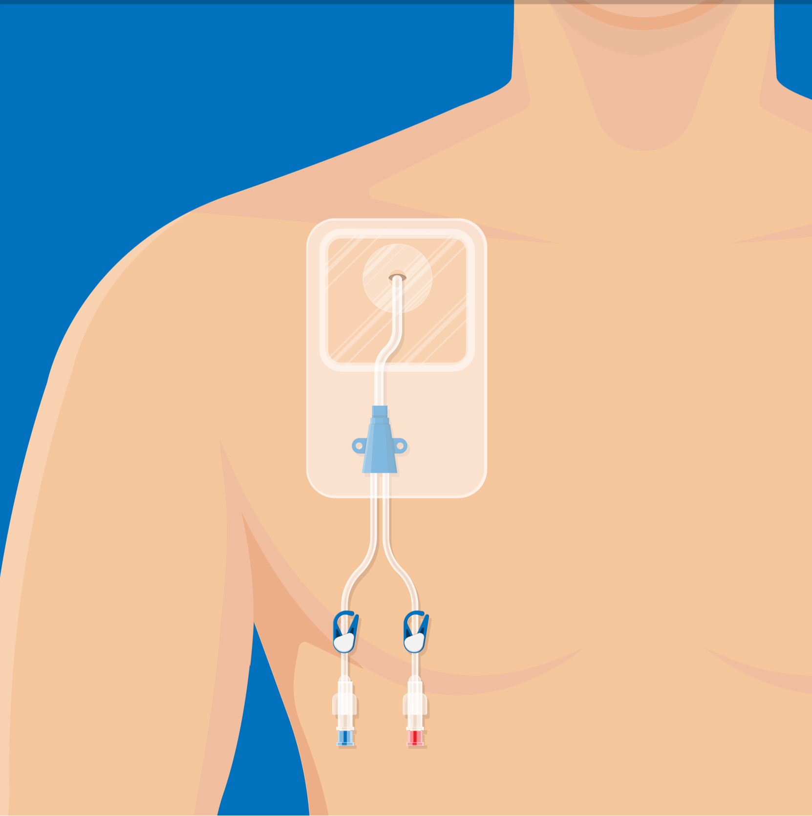 Central venous access devices-the nurse's role | HealthStaffEd