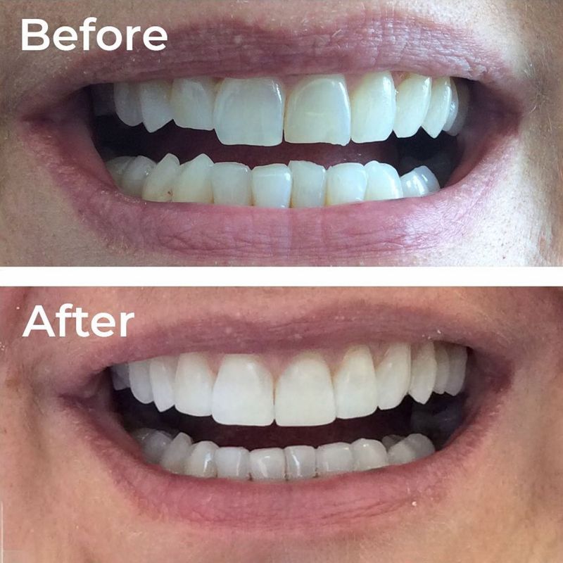 Composite Bonding Birmingham