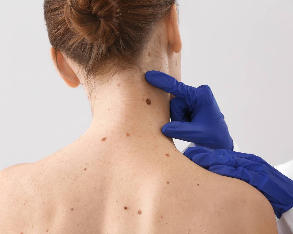 Article: 5 Signs You Should Get a Mole Checked By a Doctor