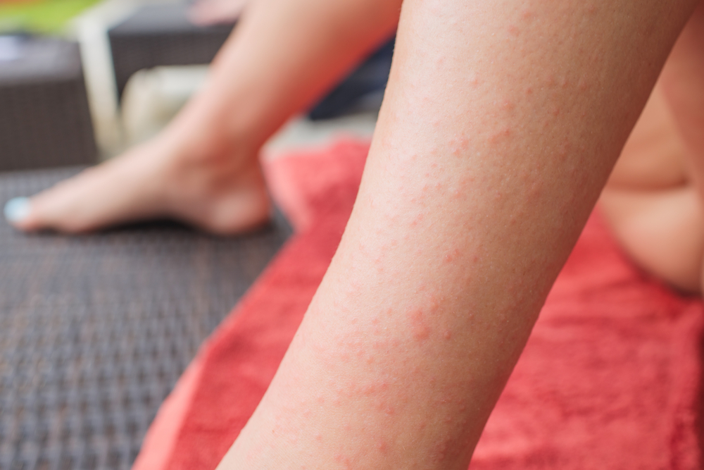 An Integrative Medicine Approach to Immunobullous (Blistering) Diseases