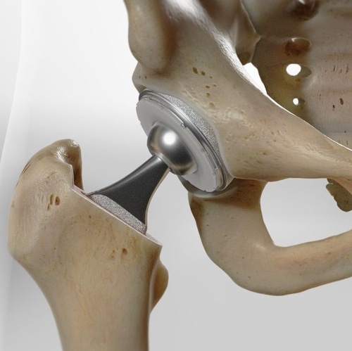 Blog: Understanding Spinal Fusion Surgery with Expandable Cages