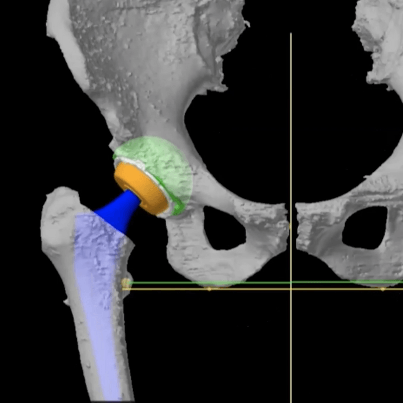Blog What Happens To Your Knee Ligaments During Knee Replacement Surgery