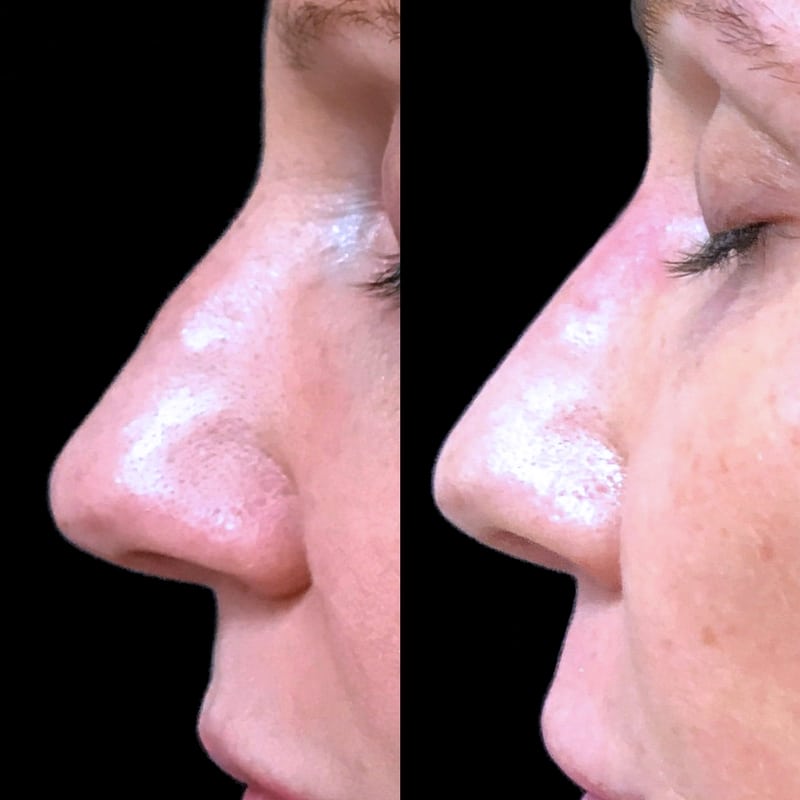 Before & After Photos Nose Reshaping | NYC