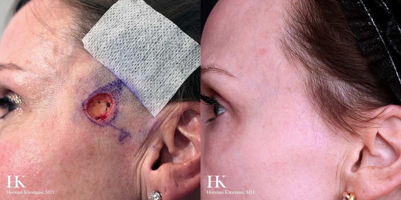 Before & After Photos Mohs Micrographic Surgery & Reconstruction ...