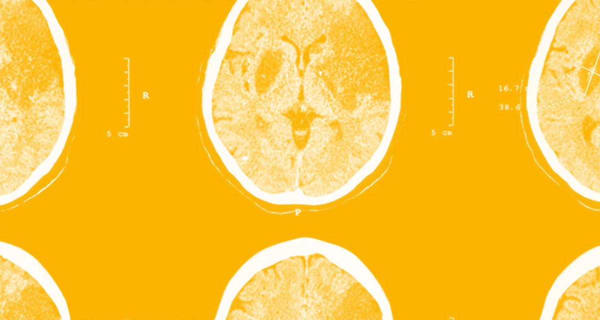 Reconnaître un AVC : les 4 signes qui doivent vous alerter
