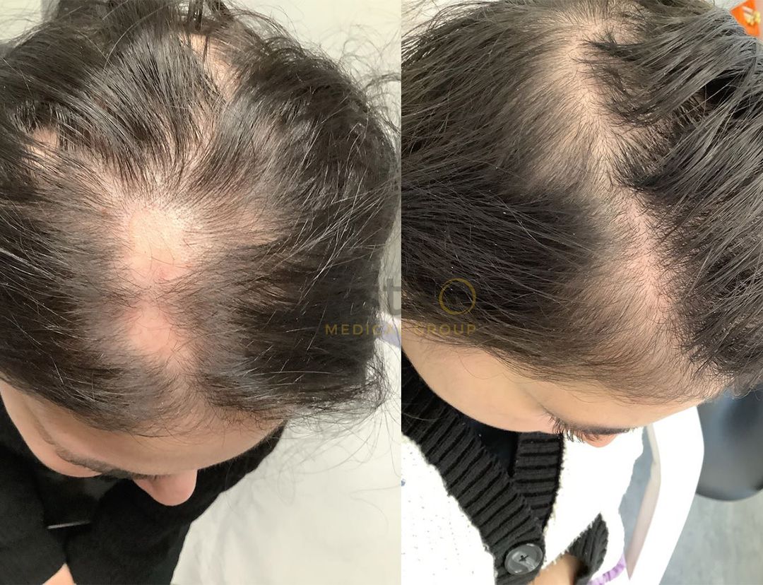 Alopecia Treatment Nottingham | Alopecia Specialists - Este