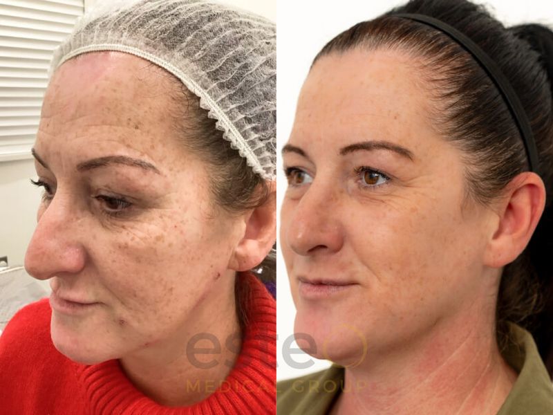 Morpheus8 | Morpheus8 Before and After | Este Medical