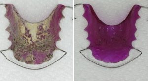 Q: What Is The White Buildup On My Retainer? | Dental Image Therapy Centres