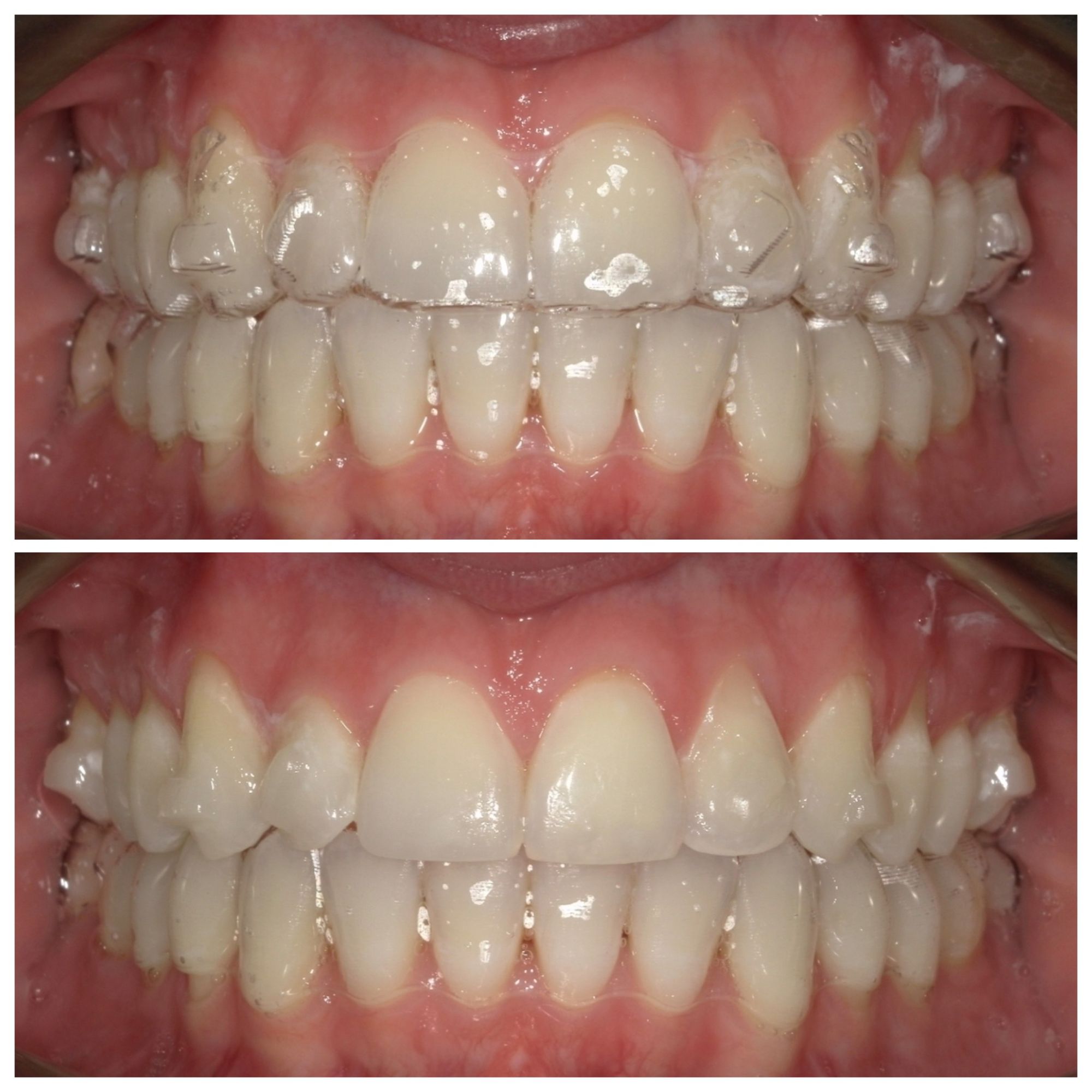 Aligned Orthodontics | Manchester Orthodontist | What is a RME or Rapid ...