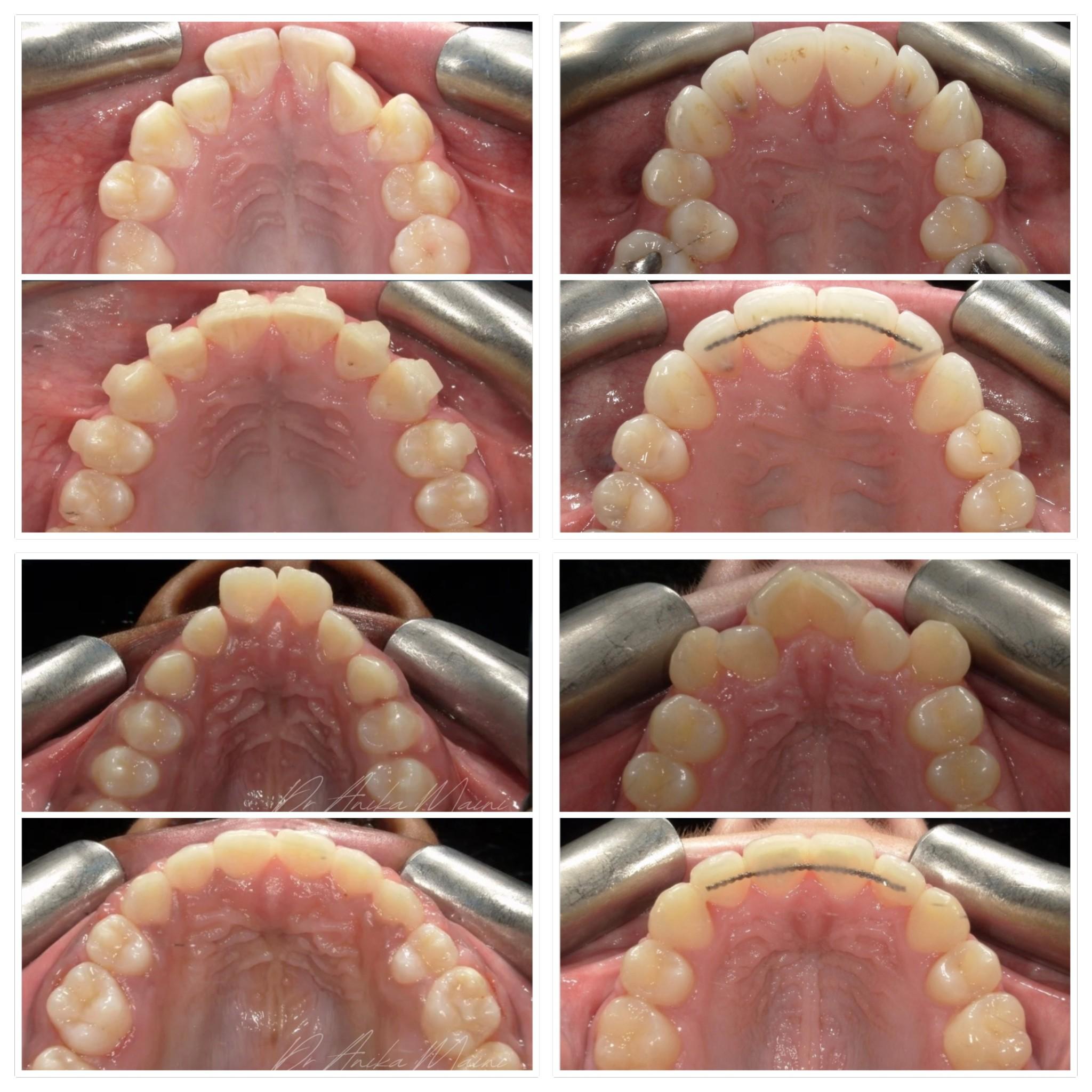 Aligned Orthodontics | Manchester Orthodontist | MARPE in Manchester ...