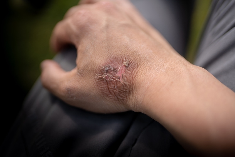 Diagnosis and Treatment of Superficial Partial-thickness Burns