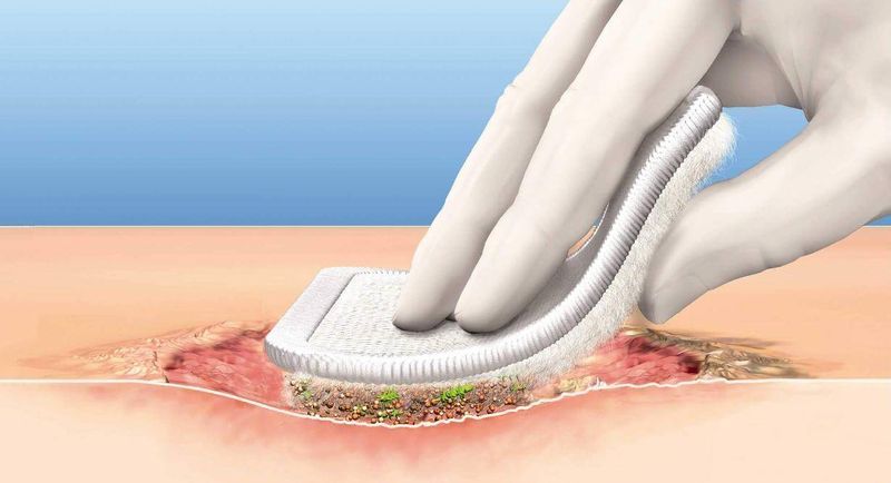 Wound Cleansers provide great benefits for Wound Management