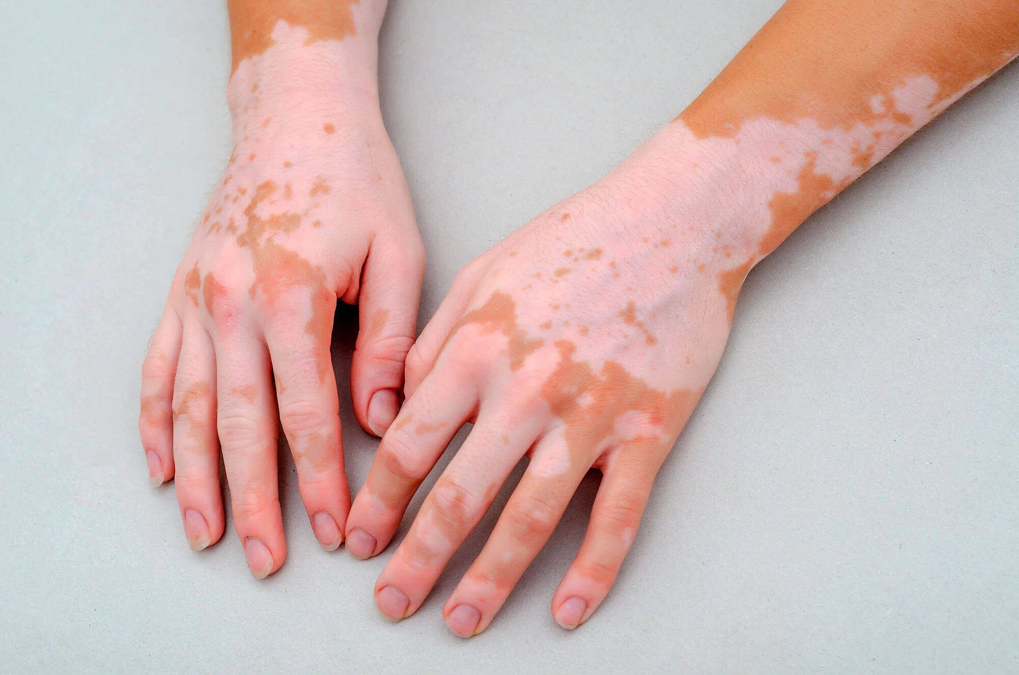 Vitiligo: Etiologia, Diagnóstico e Tratamento