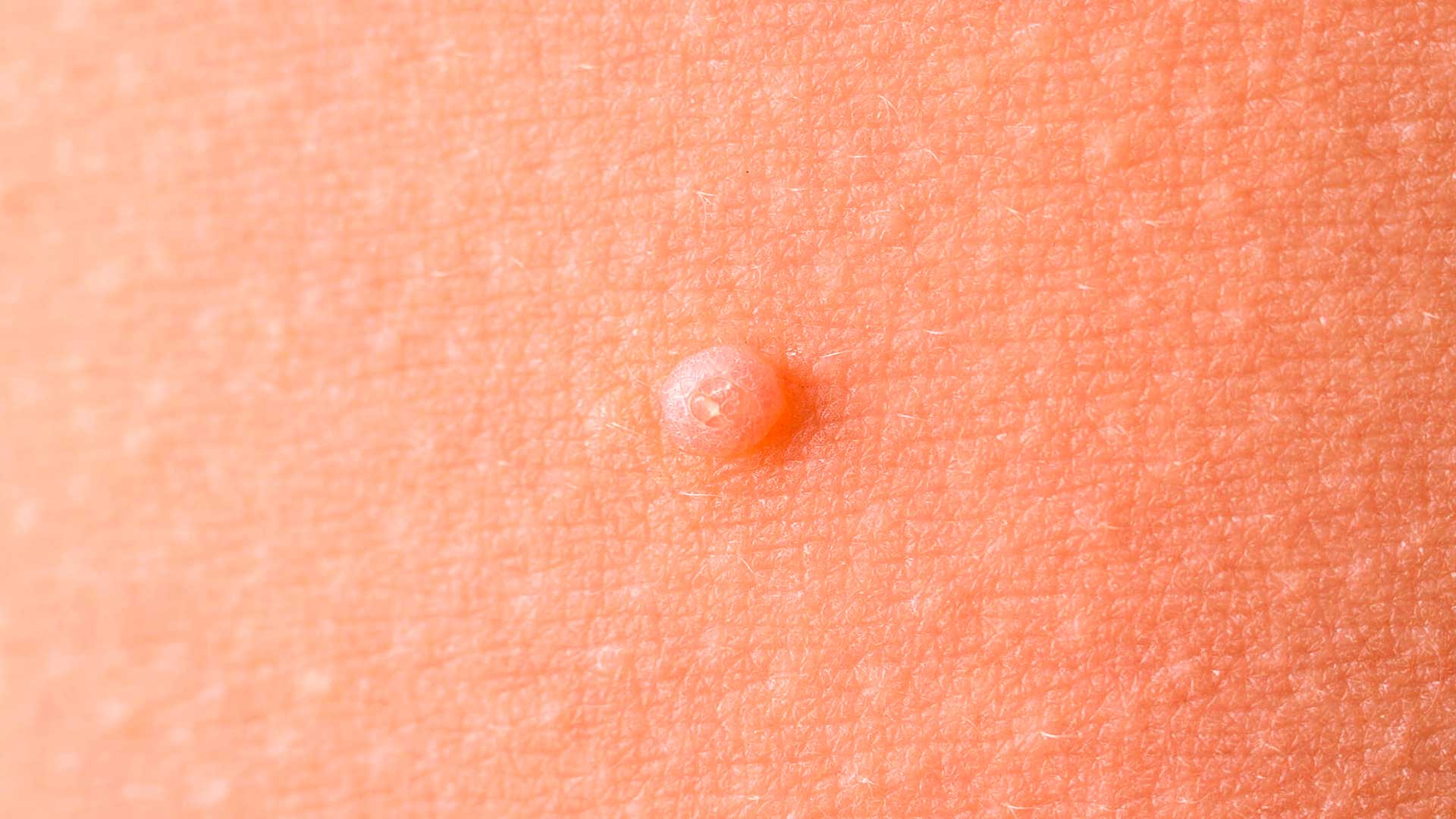 Molusco contagioso: Fisiopatologia, Causas e Tratamento