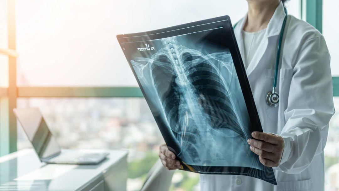 Tuberculose pulmonar: sintomas, diagnóstico e tratamento
