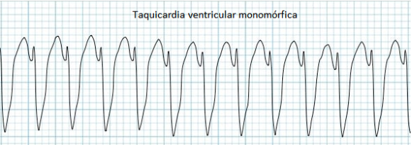 Taquiarritmia: causas, tipos, manifestações clínicas e manejo