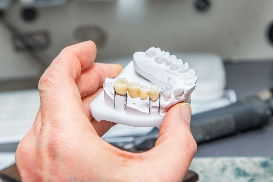 There are Four Types of Dental Bridges to Fill Gaps in Your Teeth