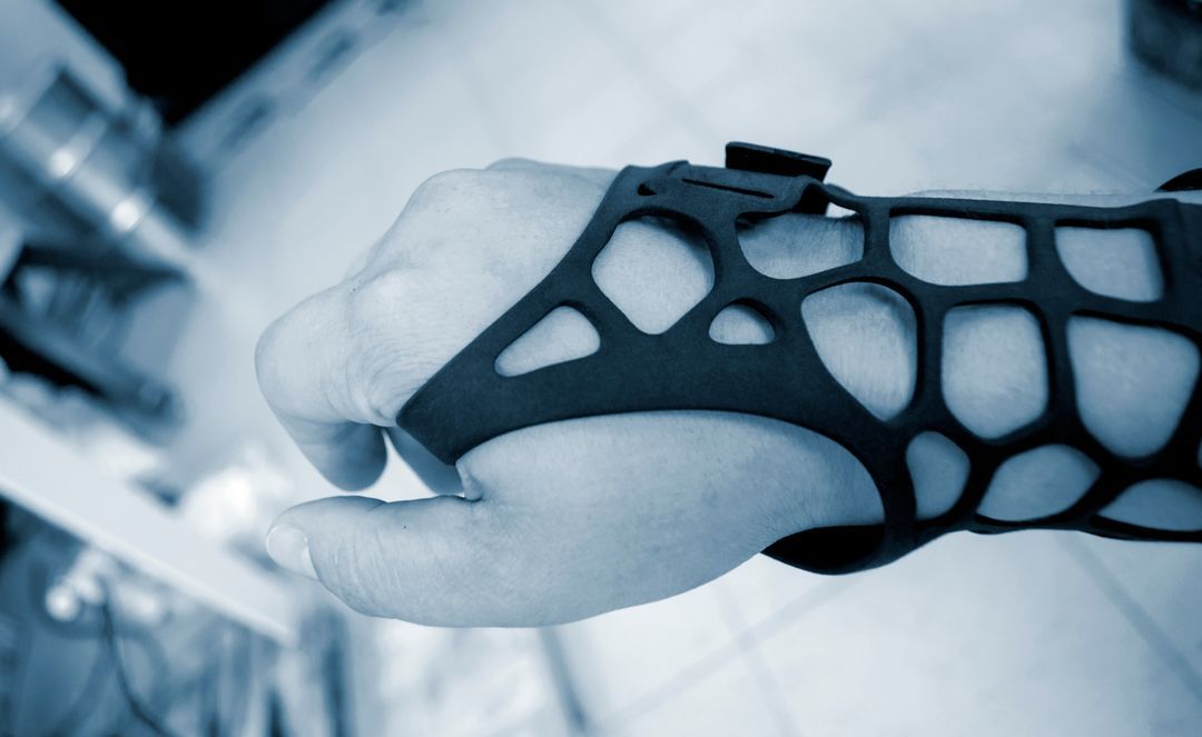 Are 3D Printed Casts the Right Choice for You?