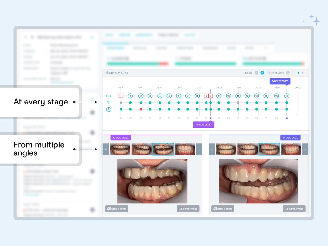 Remote Monitoring for Clear Aligners — Less Chair Time | CandidPro
