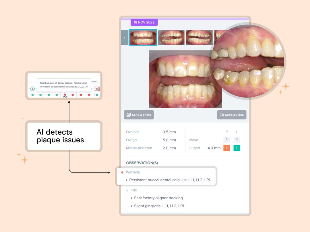 Remote Monitoring for Clear Aligners — Less Chair Time | CandidPro