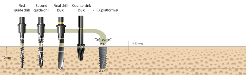 SuperLine Implants