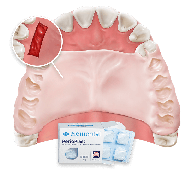 Elemental | Palatal grafting without worries. No suturing. No pain.