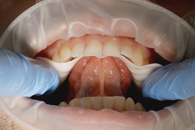 Get Started with Elemental | Make your first stent.
