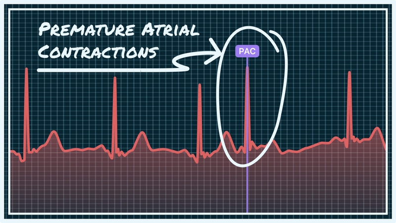 What Premature Atrial Contraction (PAC) Looks Like on Your Watch ECG | Qaly
