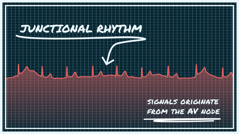 What Junctional Rhythm Looks Like on Your Watch ECG | Qaly