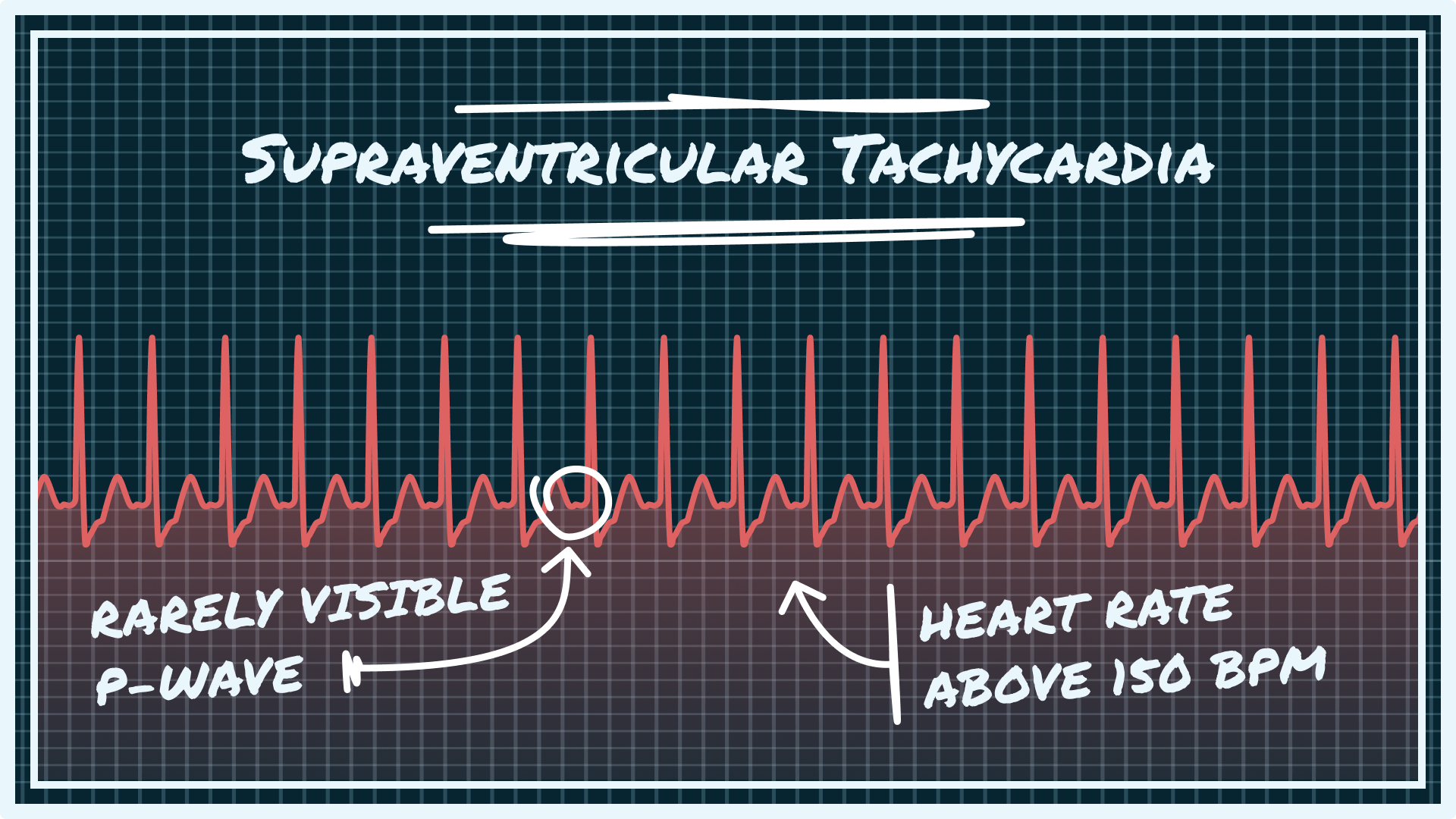 Svt Rhythm Example Supraventricular Tachycardia Knowledge AMBOSS Svt Rhythm Example Supraventricular Tachycardia Knowledge AMBOSS