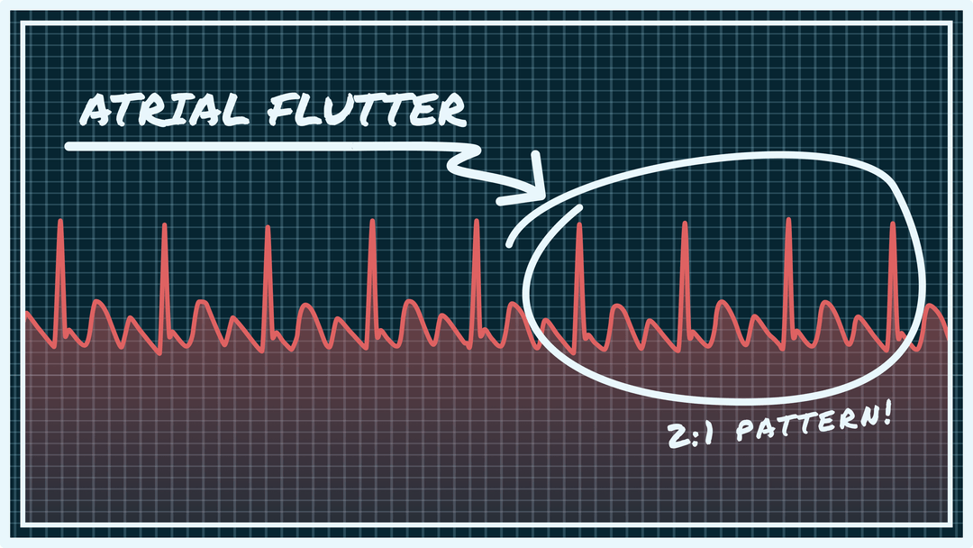 What Atrial Flutter Looks Like on Your Watch ECG | Qaly