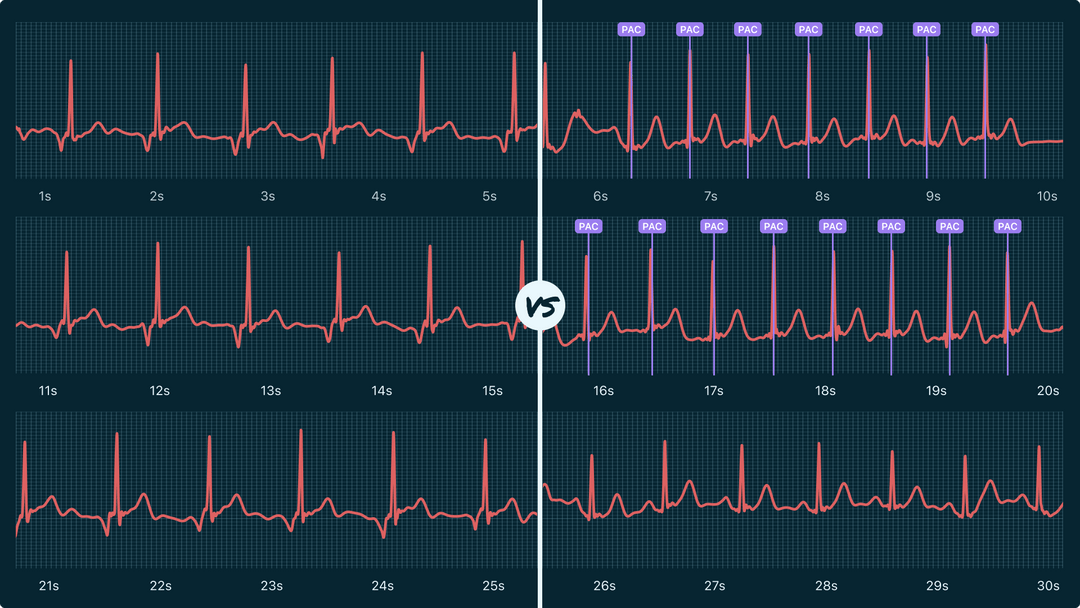 Qaly | How To Read Your ECG