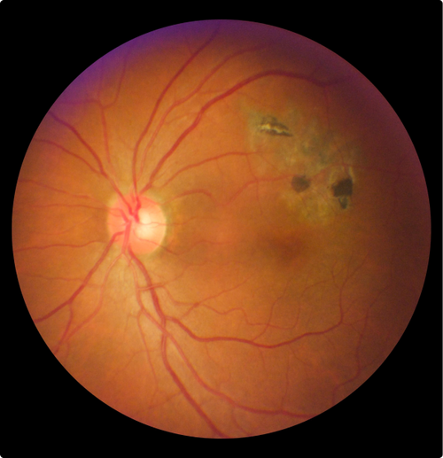 Remidio FOP NM-10 | Non Mydriatic Hand Held Fundus Camera