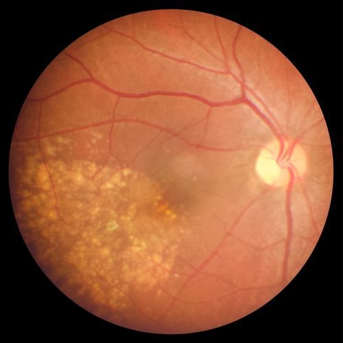 Remidio FOP NM-10 | Non Mydriatic Hand Held Fundus Camera