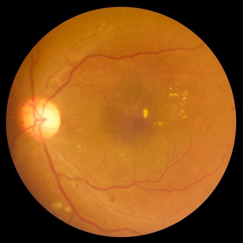 Remidio FOP NM-10 | Non Mydriatic Hand Held Fundus Camera