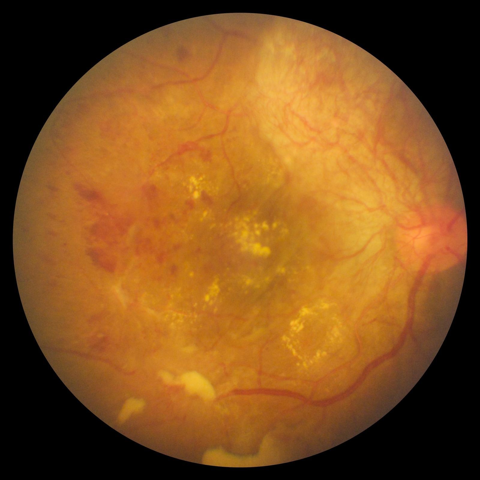 Remidio FOP NM-10 | Non Mydriatic Hand Held Fundus Camera