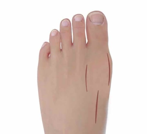 Bunion Correction Surgery | Arthrex Bunionectomy