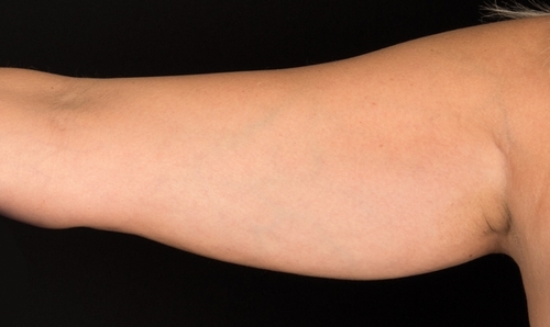 Coolsculpting – Fat Freezing Treatment in Dubai