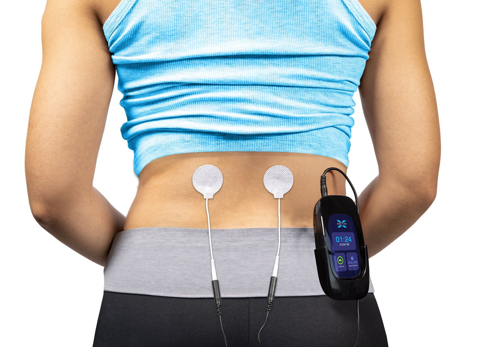 Xstim, Spine Fusion Stimulation Therapy