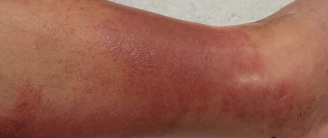 Erisipela: conheça as causas e tratamentos para a doença