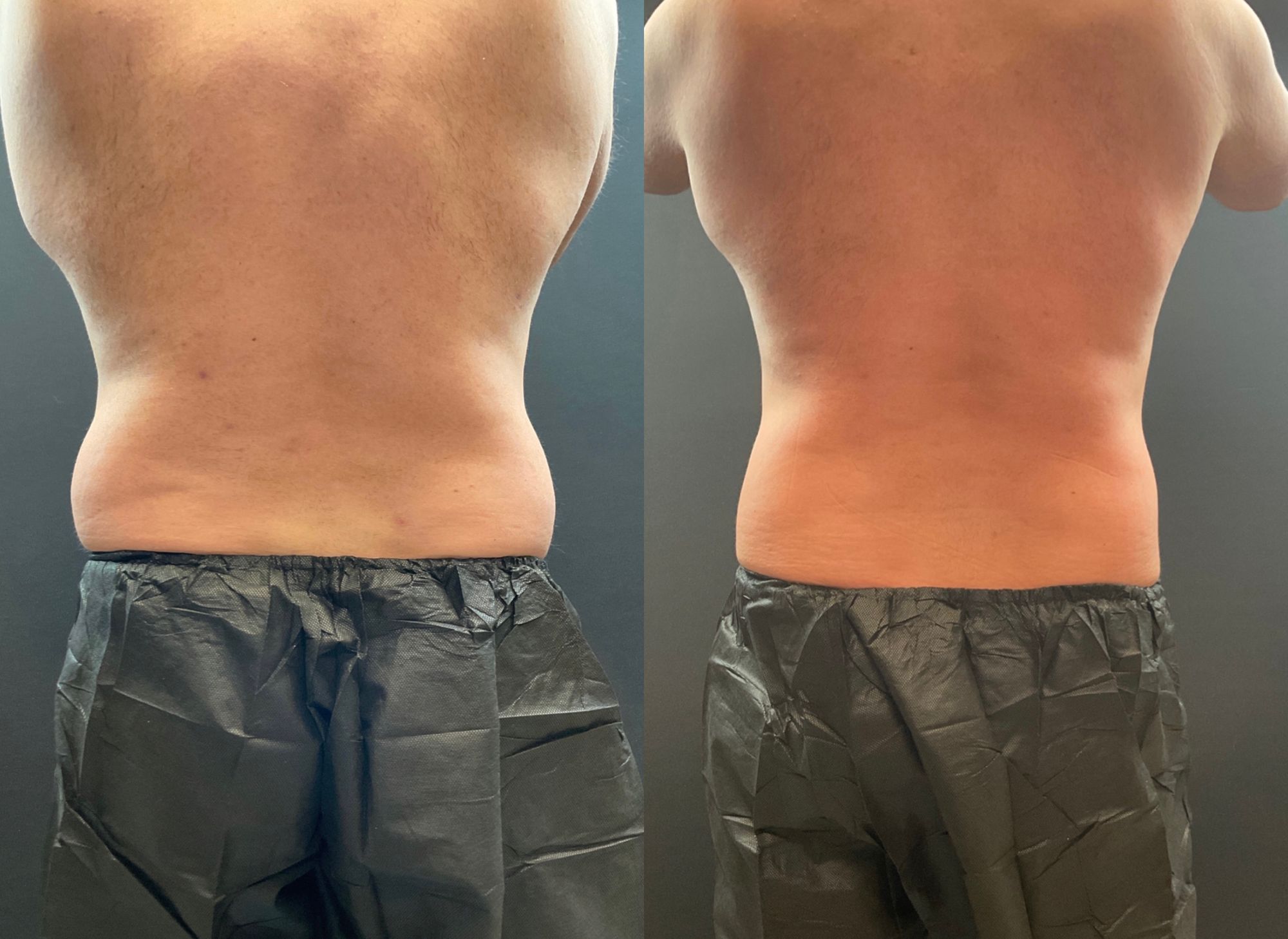 Morpheus8 Face and Neck Before and After | AOB Med Spa Denver