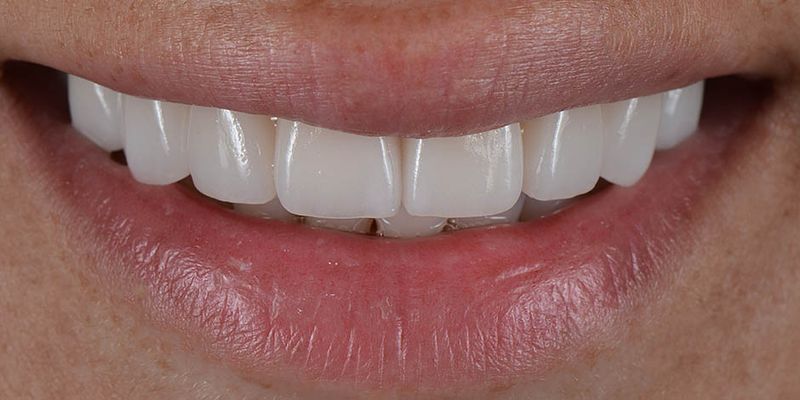 Zubní fazety do týdne | Keramické fazety na zuby | DENTALABS