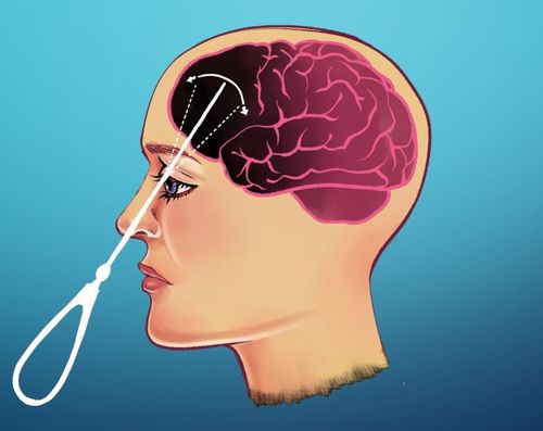 The history of lobotomy